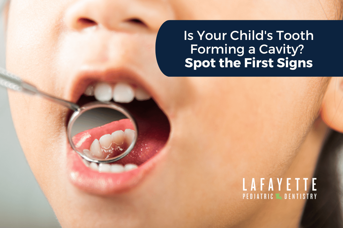Is Your Child's Tooth Forming a Cavity? Spot the First Signs ...